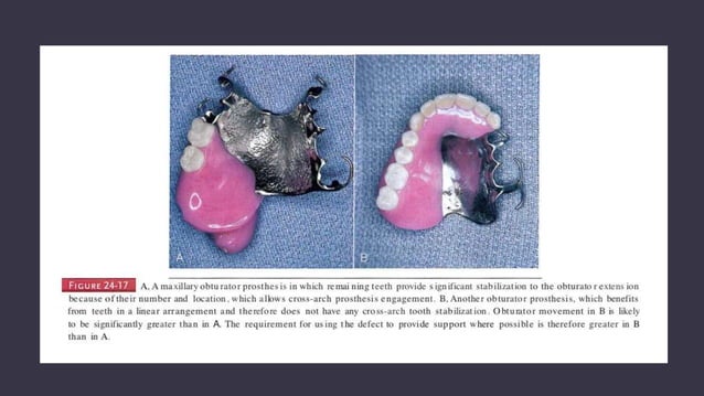 Rpd consideration in maxillofacial prosthetics | PPTX | Ear, Nose and ...