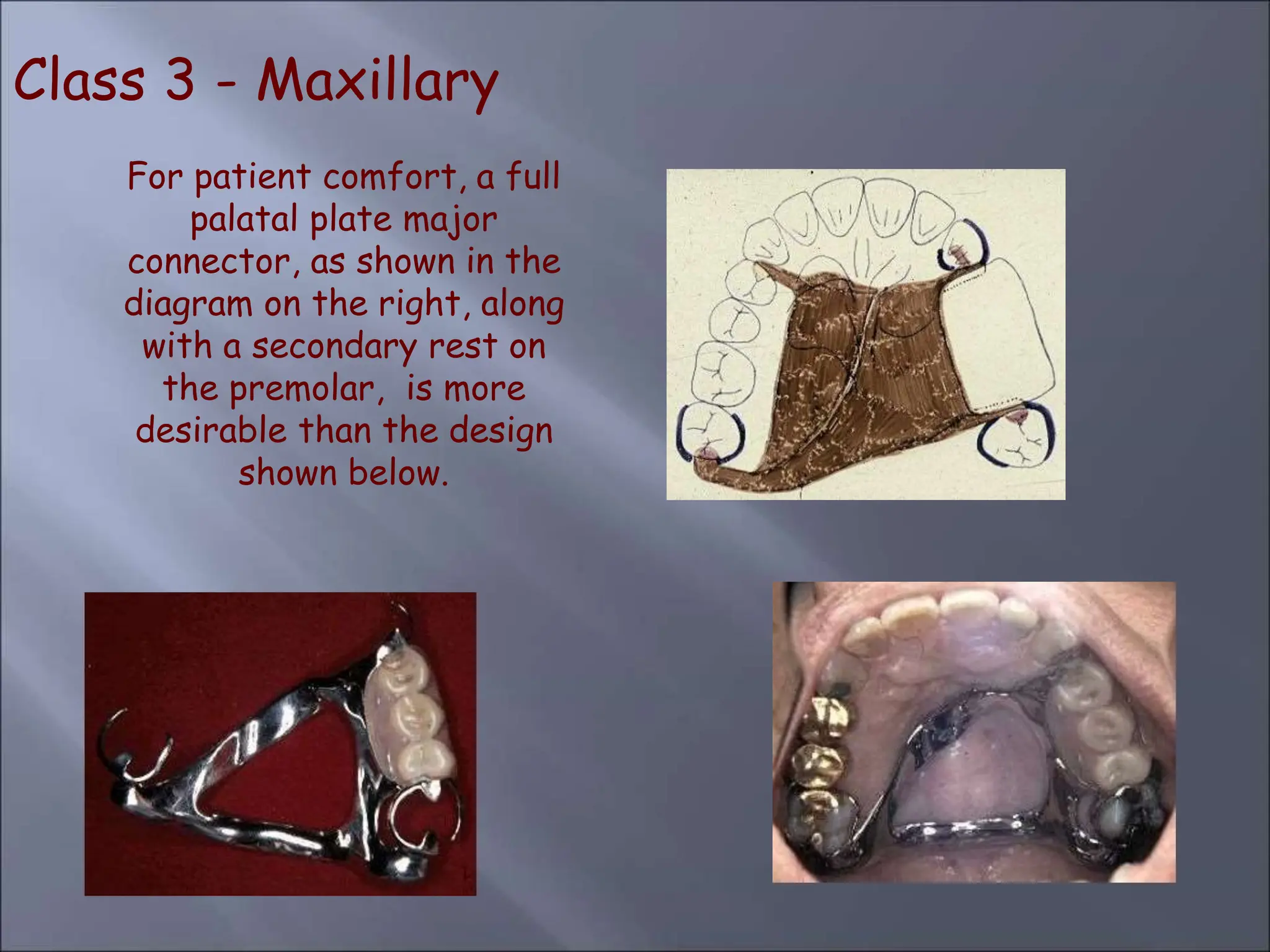 RPD_design_considerations basicspart 2ppt.ppt | Free Download