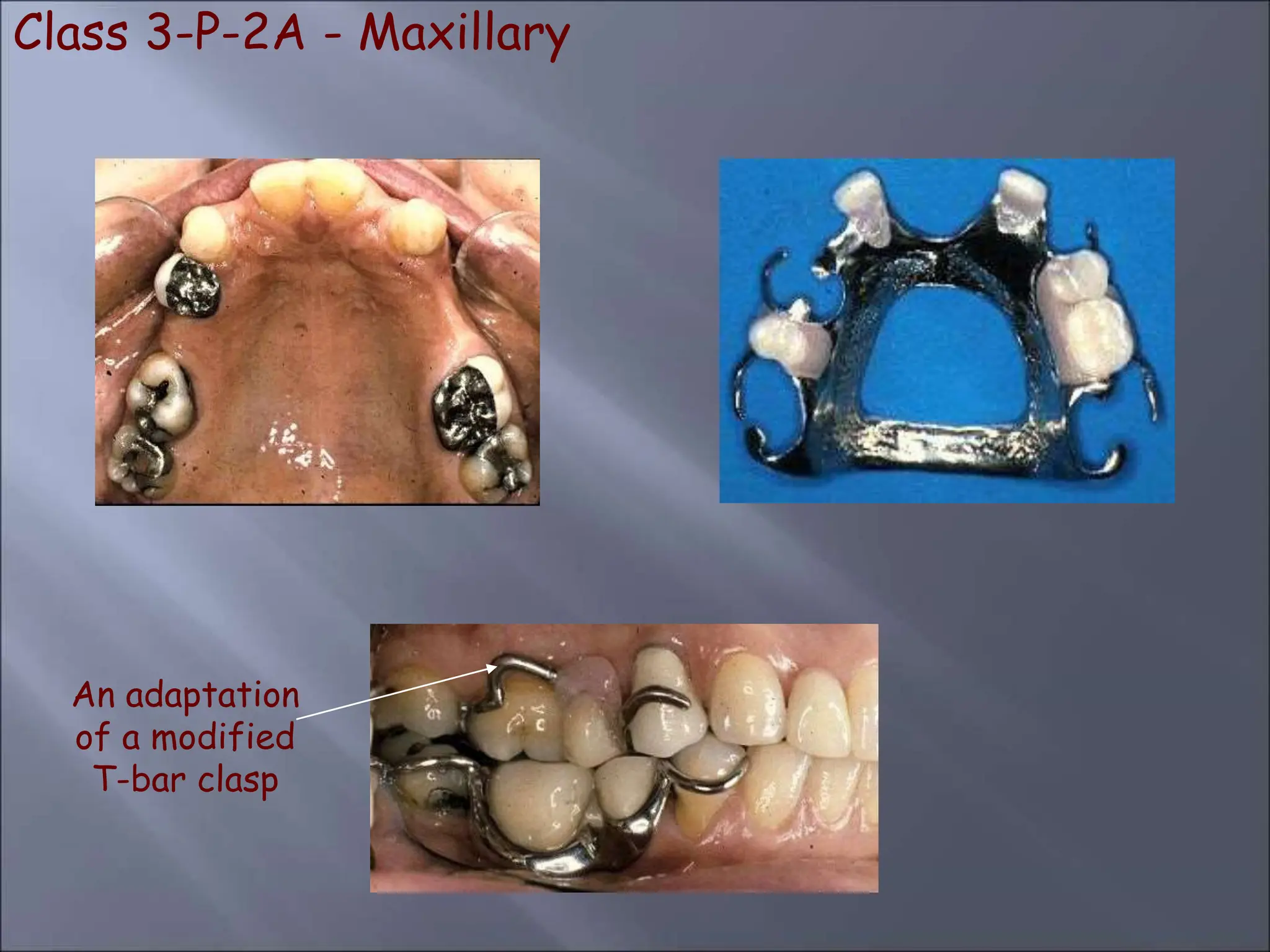 RPD_design_considerations basicspart 2ppt.ppt