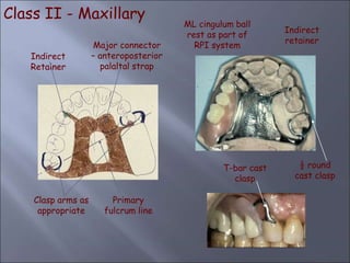 RPD_design_considerations basicspart 2ppt.ppt