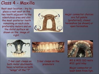RPD_design_considerations basicspart 2ppt.ppt