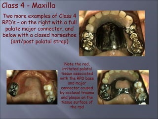 RPD_design_considerations basicspart 2ppt.ppt