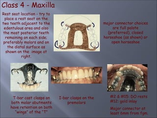 RPD_design_considerations and fabrication part 2ppt.ppt