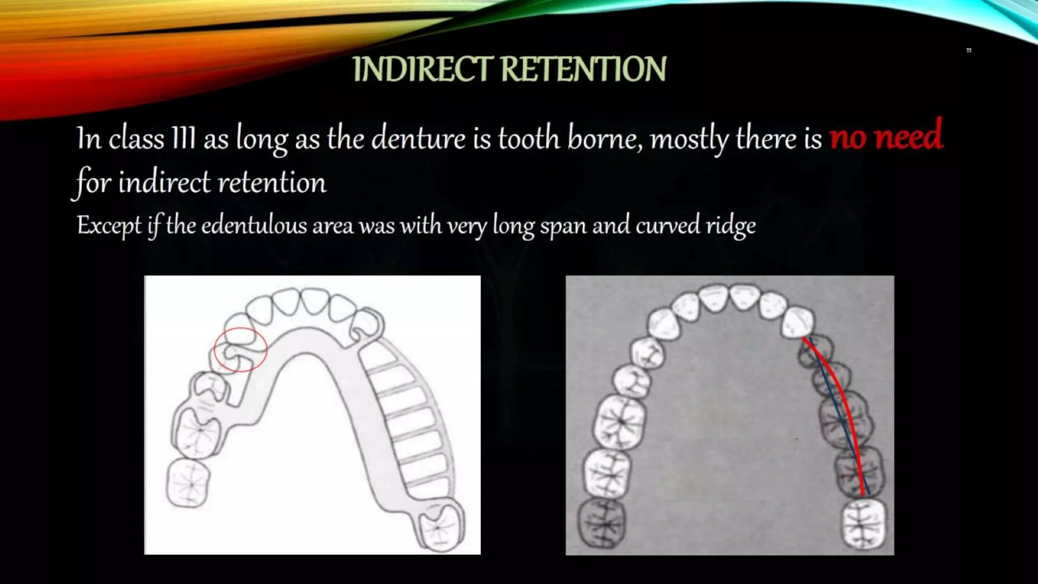 removable partial denture RPD design part 2 | PPTX | Oral care ...