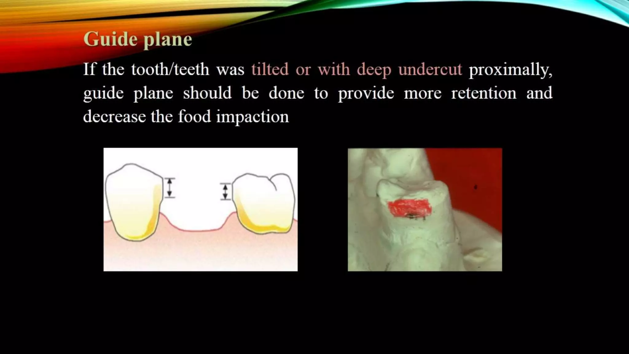 removable partial denture RPD design part 2 | PPTX | Oral care ...