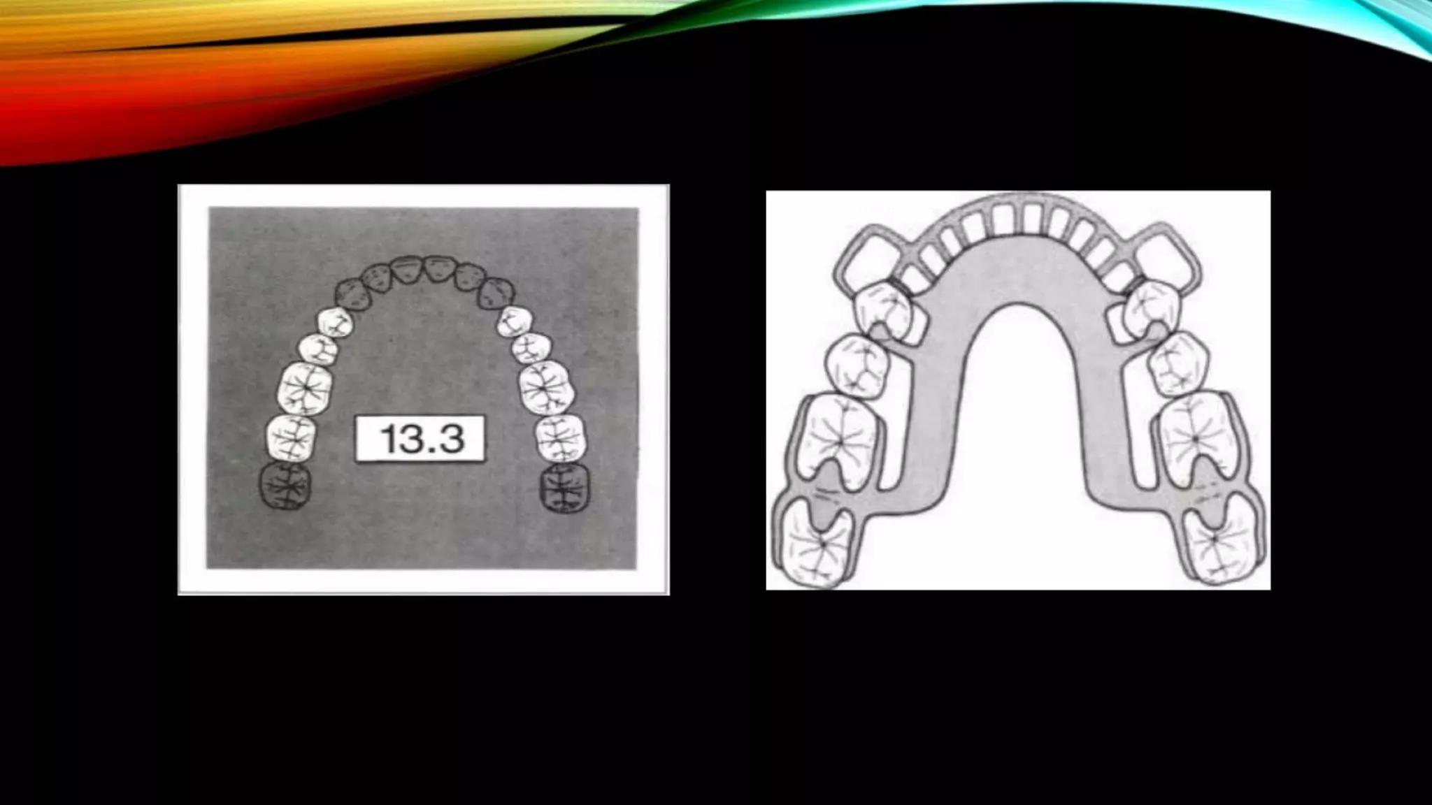 removable partial denture RPD design part 2 | PPTX | Oral care ...