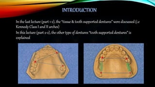 removable partial denture RPD design part 2 | PPTX