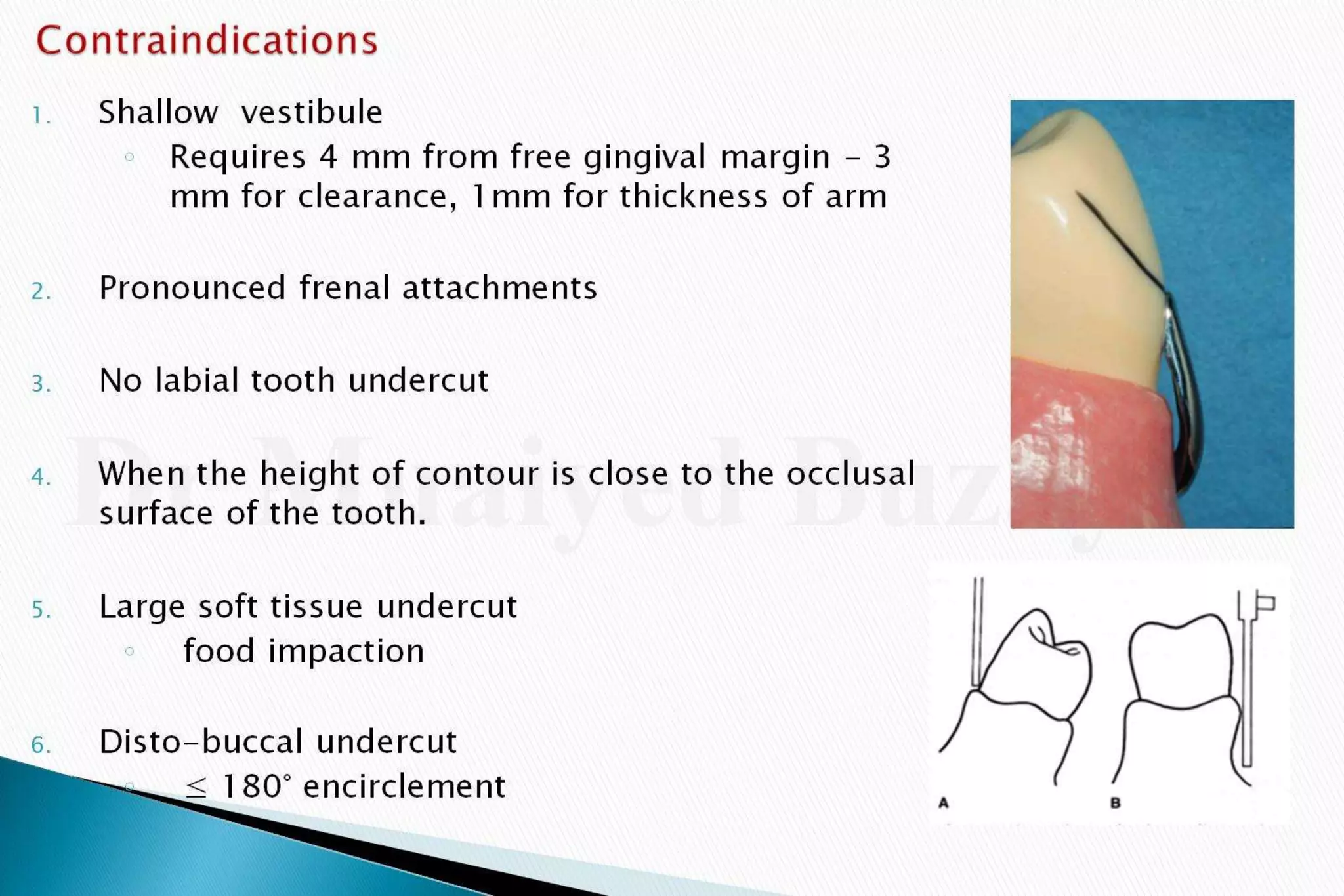 Rpd direct retainers 2nd yr | PPTX