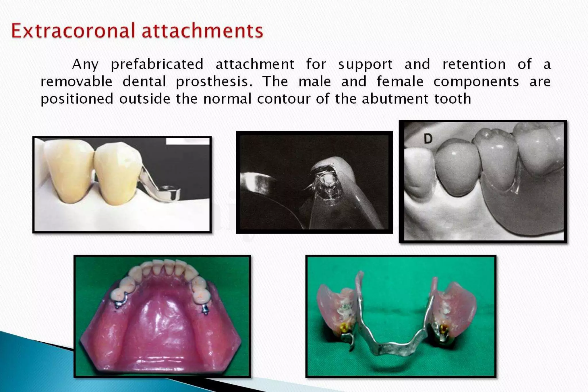 Rpd direct retainers 2nd yr | PPTX