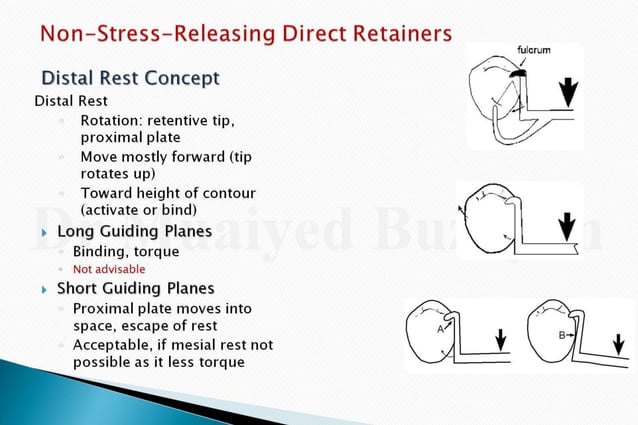 Rpd direct retainers 2nd yr | PPTX