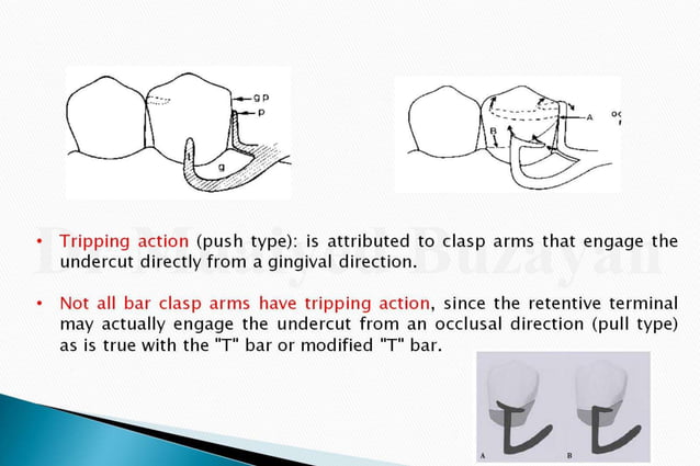 Rpd direct retainers 2nd yr | PPTX