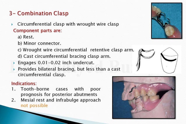 Rpd direct retainers 2nd yr | PPTX