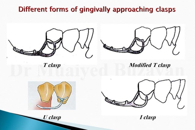 Rpd direct retainers 2nd yr