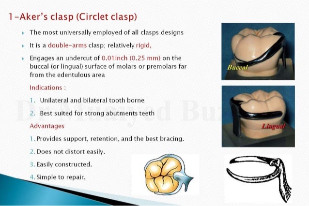 Rpd direct retainers 2nd yr