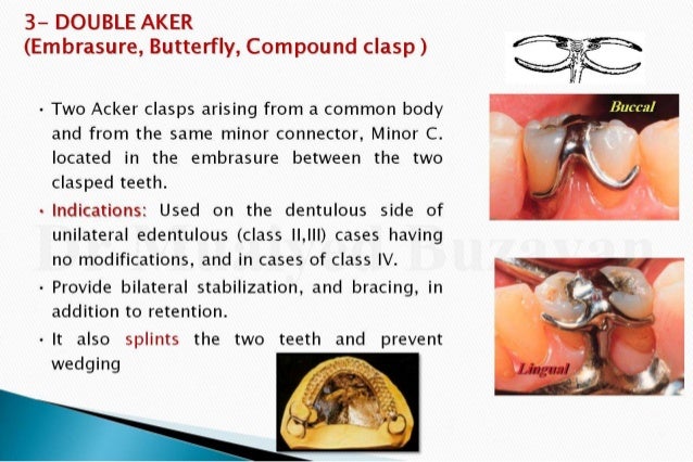 Rpd direct retainers 2nd yr