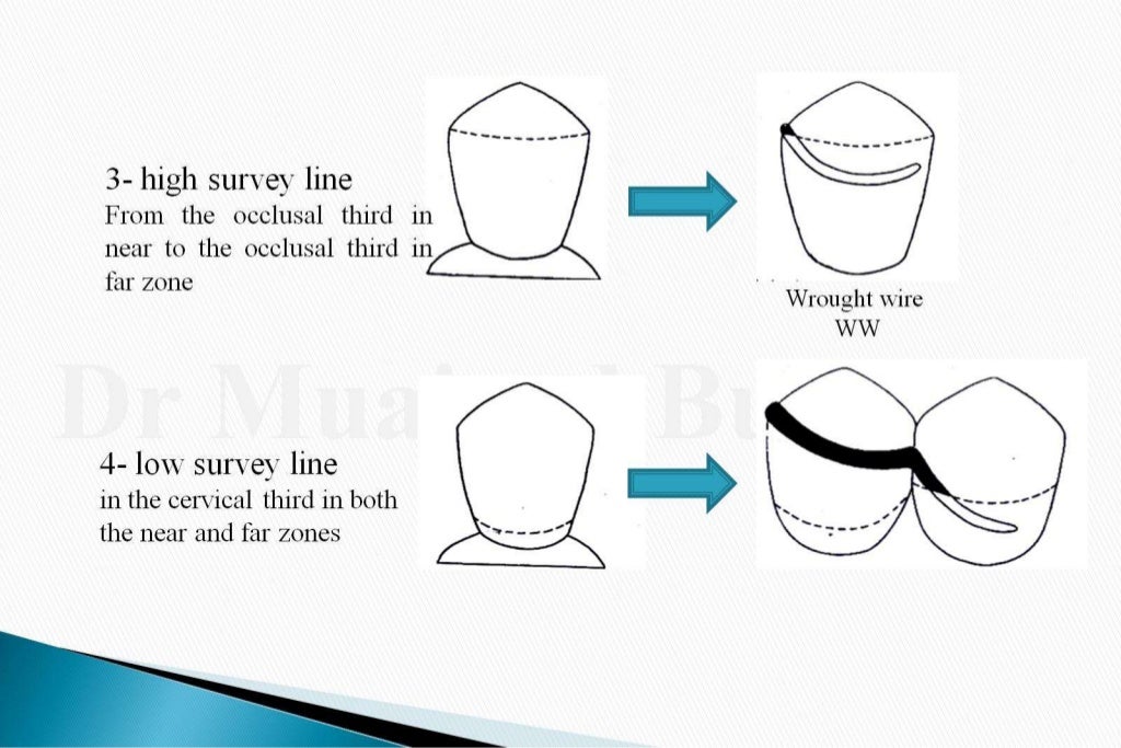 Rpd direct retainers 2nd yr
