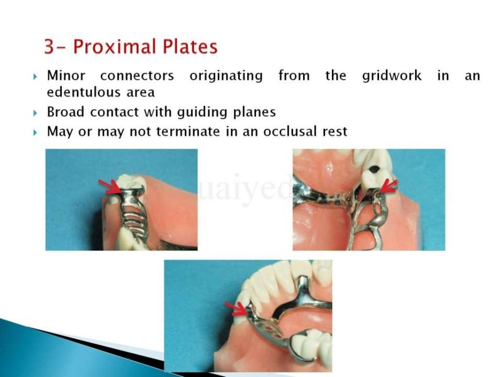 Rpd minor connectors 2nd yr