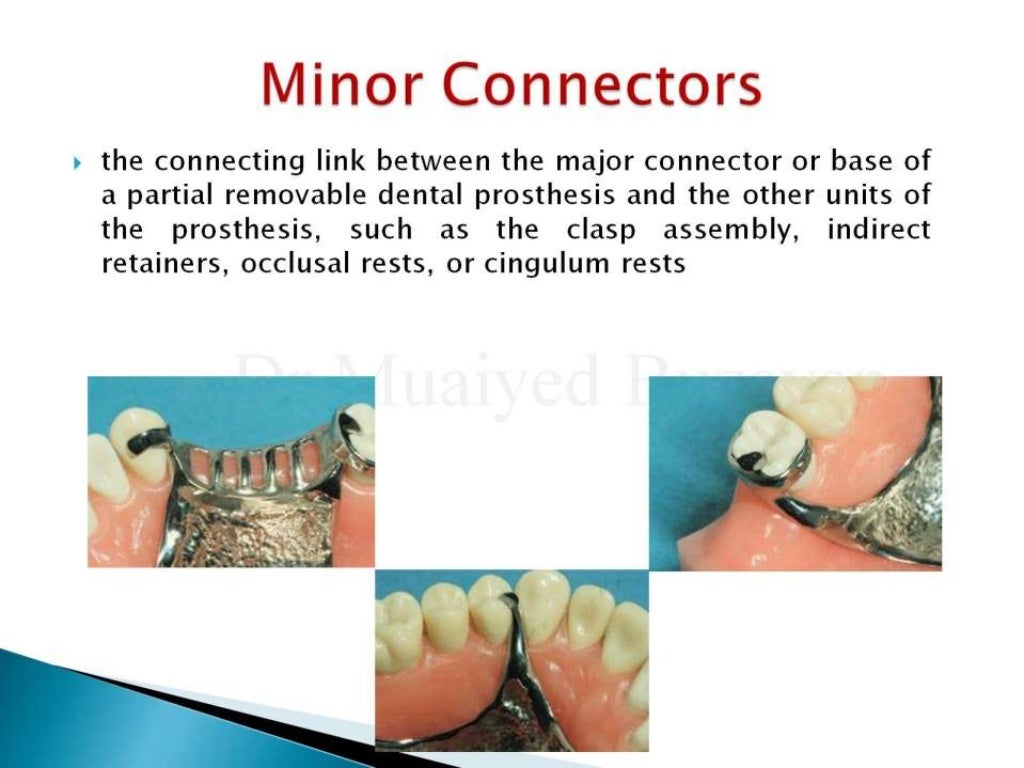 Rpd minor connectors 2nd yr