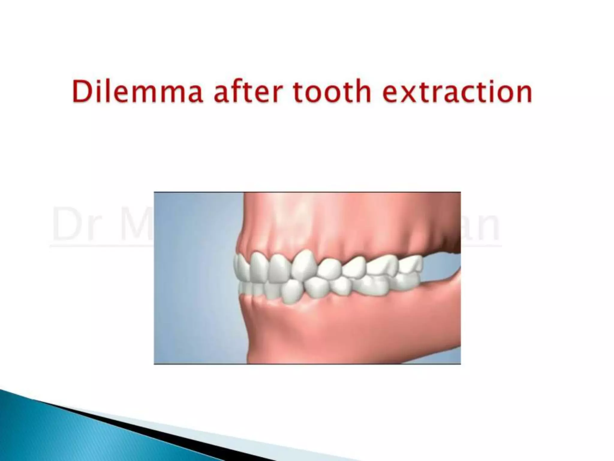 Rpd removable partial denture introduction 2nd yr | PPTX