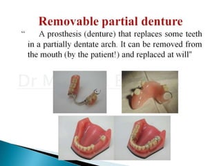 Rpd removable partial denture introduction 2nd yr | PPT