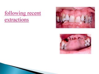 Rpd removable partial denture introduction 2nd yr | PPTX