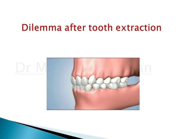 Rpd removable partial denture introduction 2nd yr | PPT