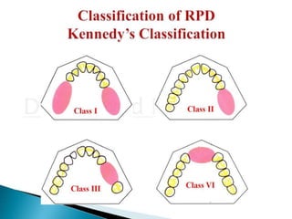 Rpd removable partial denture introduction 2nd yr | PPT