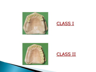Rpd removable partial denture introduction 2nd yr | PPTX