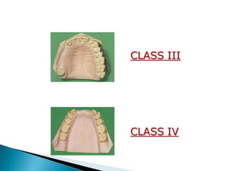 Rpd removable partial denture introduction 2nd yr | PPT