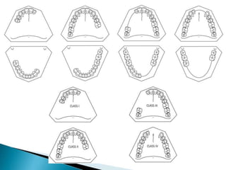 Rpd removable partial denture introduction 2nd yr | PPT