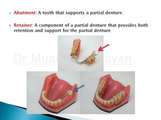 Rpd removable partial denture introduction 2nd yr | PPT