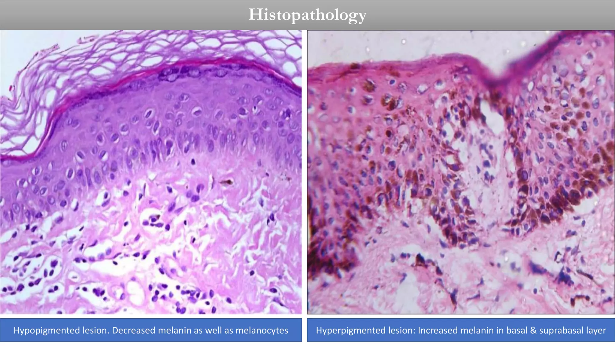 Dyschromatosis and Reticulate pigmentary disorders | PPT