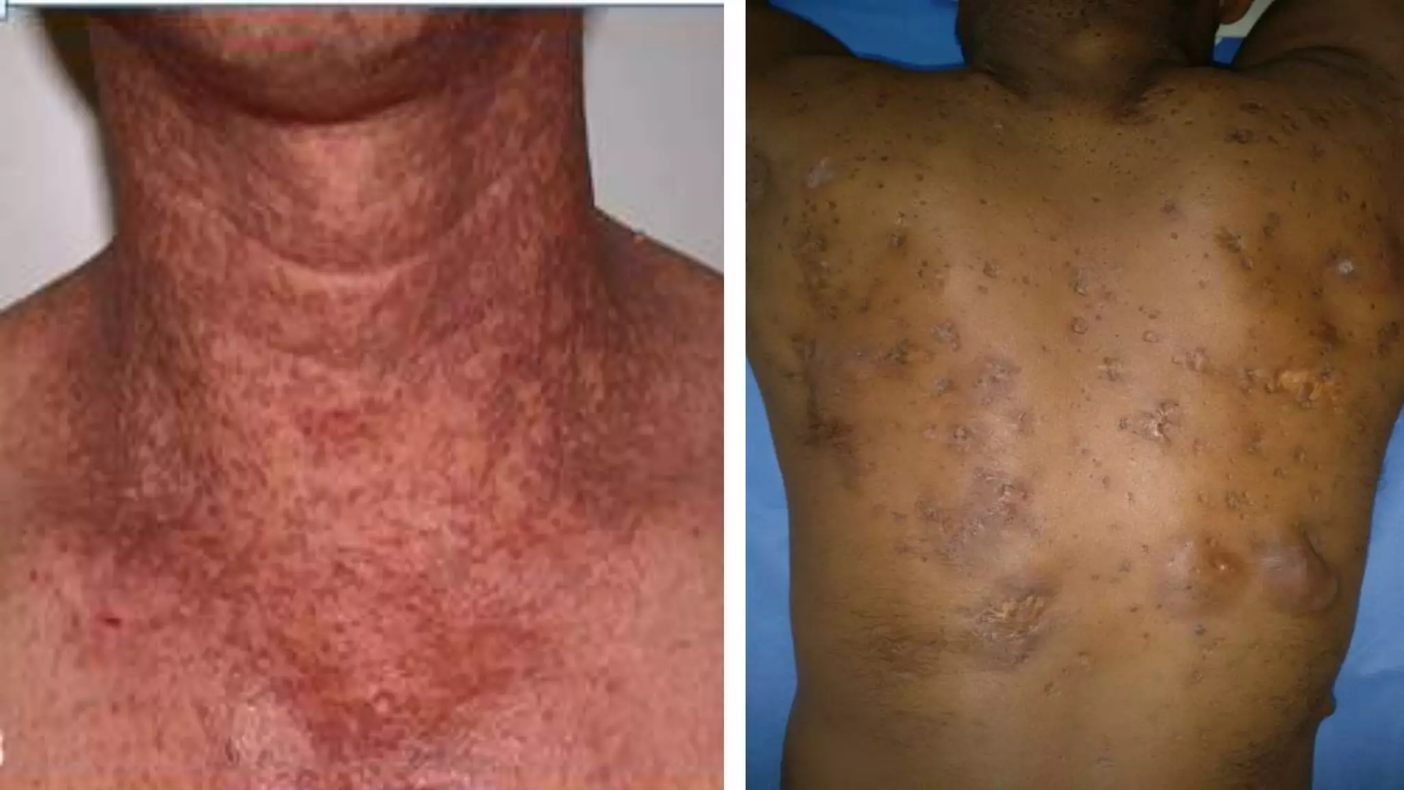 Dyschromatosis and Reticulate pigmentary disorders | PPT