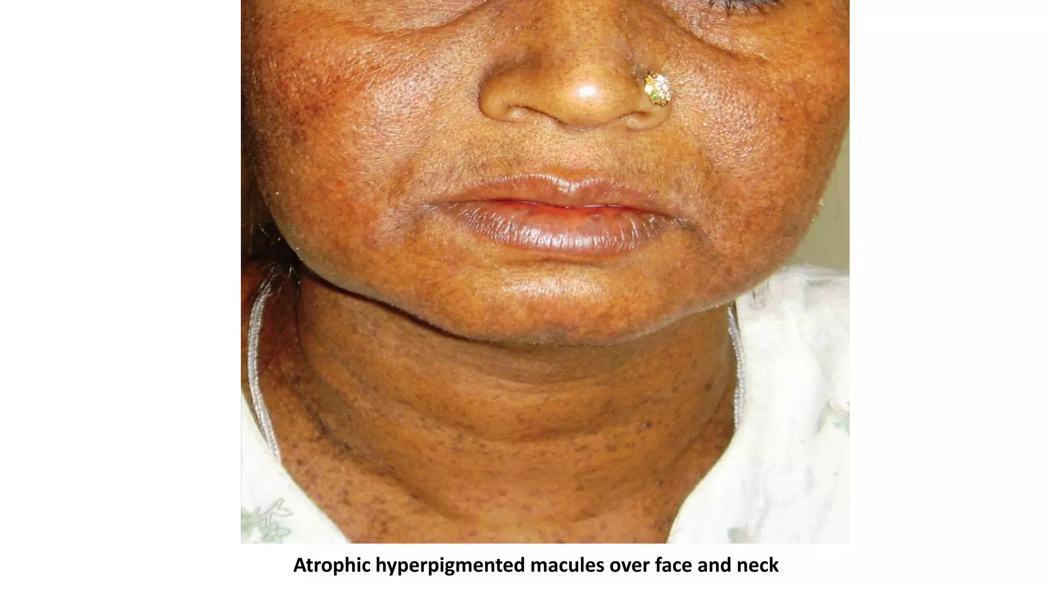 Dyschromatosis and Reticulate pigmentary disorders | PPT