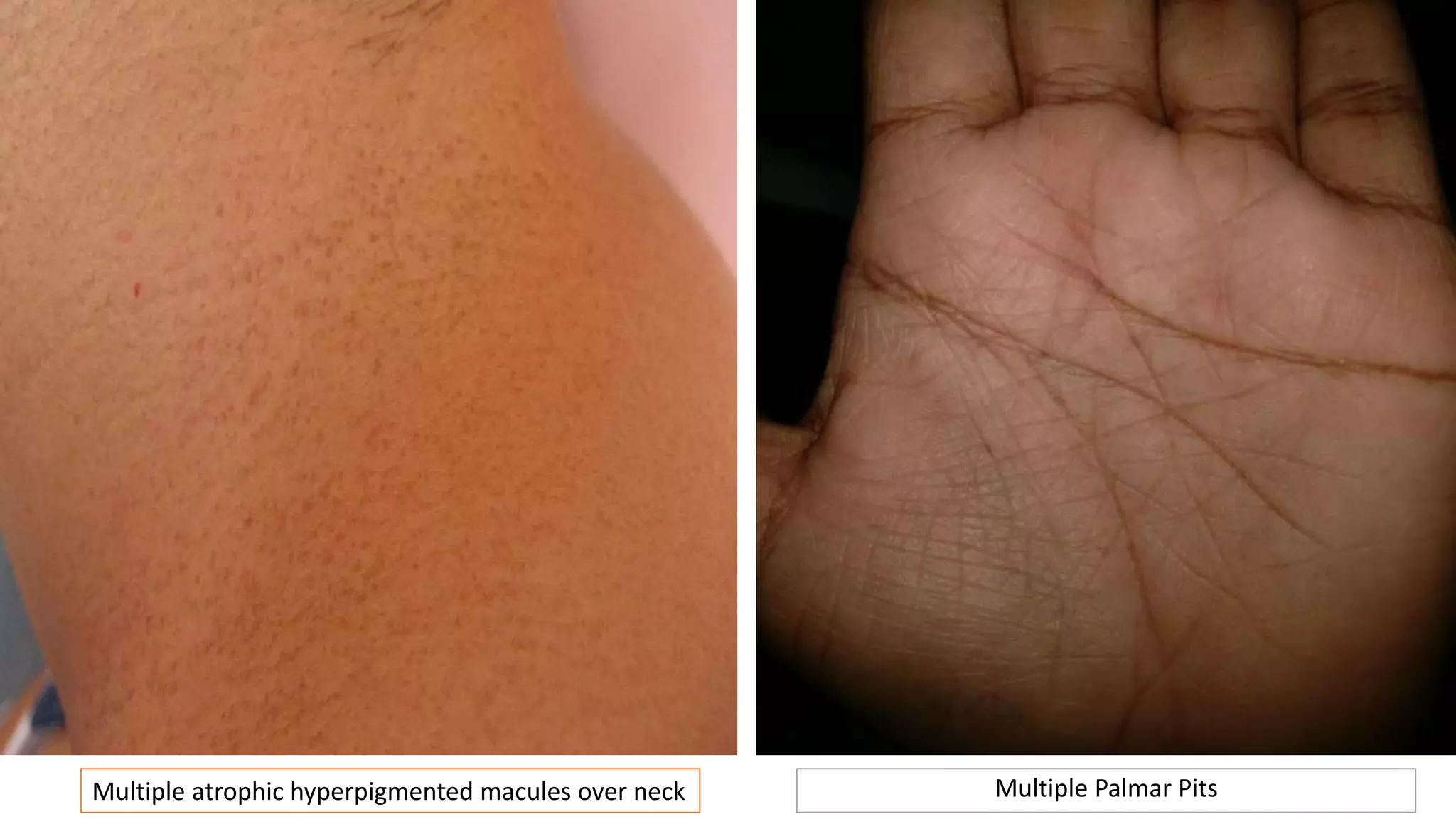 Dyschromatosis and Reticulate pigmentary disorders | PPT