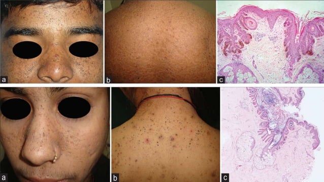 Dyschromatosis and Reticulate pigmentary disorders | PPT