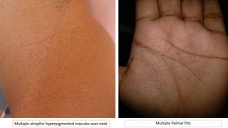 Dyschromatosis and Reticulate pigmentary disorders | PPTX