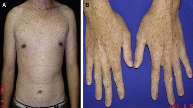 Dyschromatosis and Reticulate pigmentary disorders