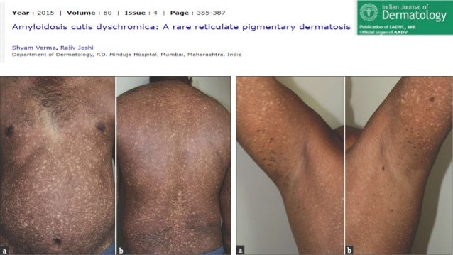 Dyschromatosis and Reticulate pigmentary disorders