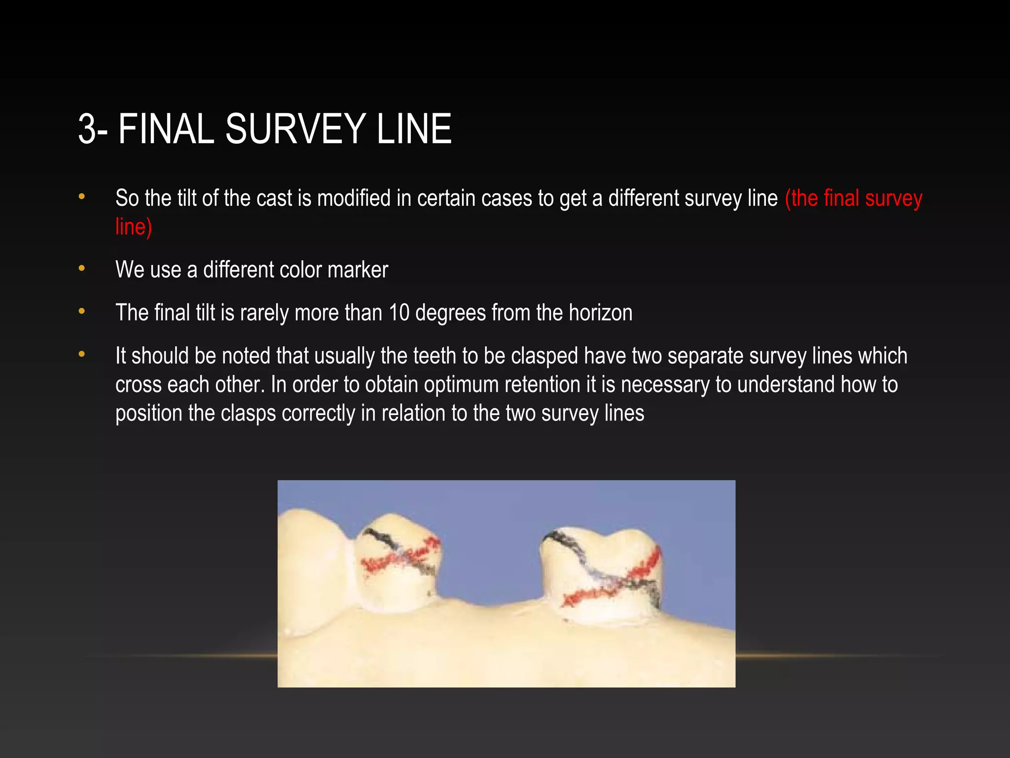 removable partial denture survey lines, path of insertion, guide planes ...
