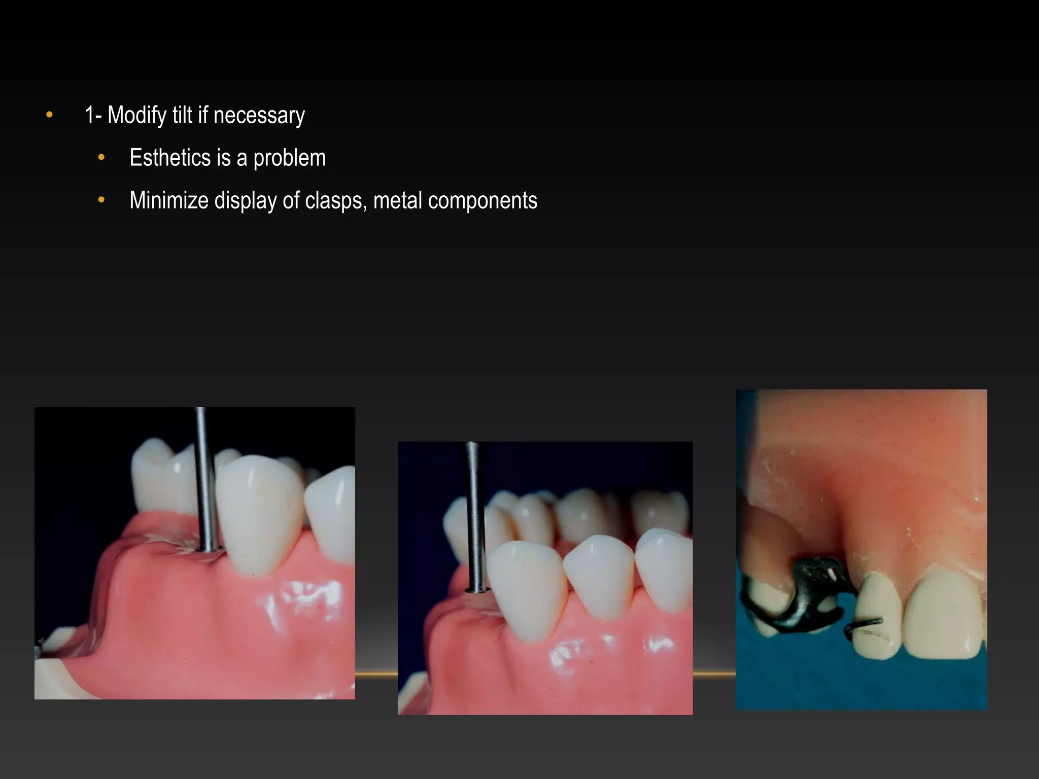 removable partial denture survey lines, path of insertion, guide planes ...