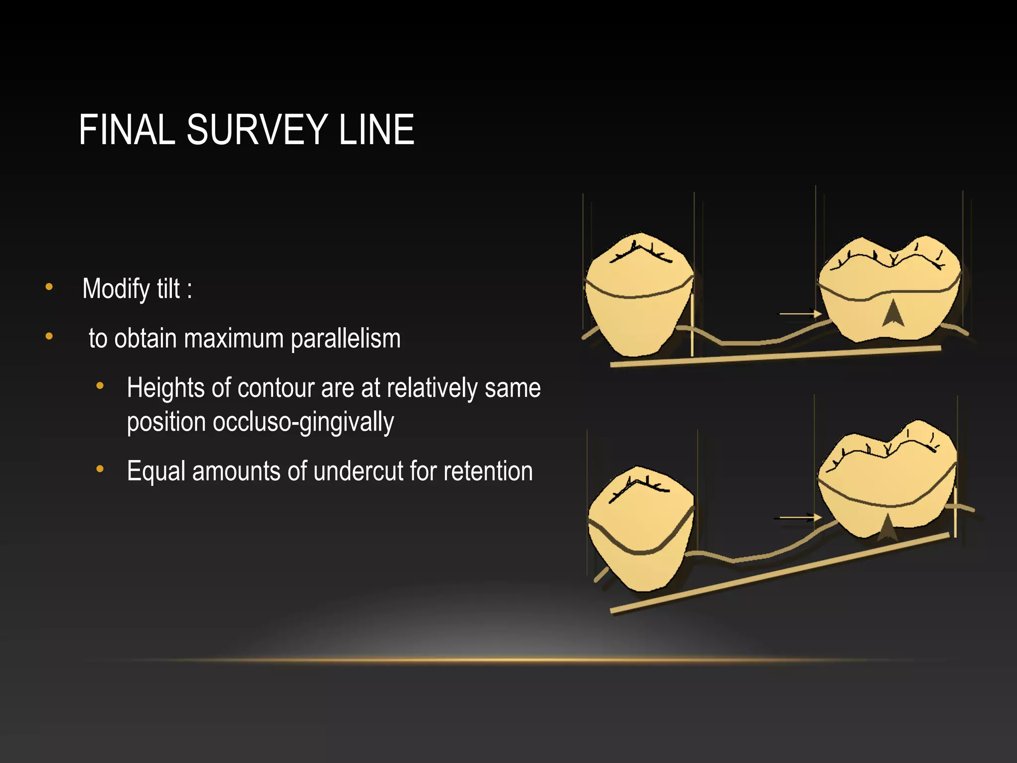 removable partial denture survey lines, path of insertion, guide planes ...