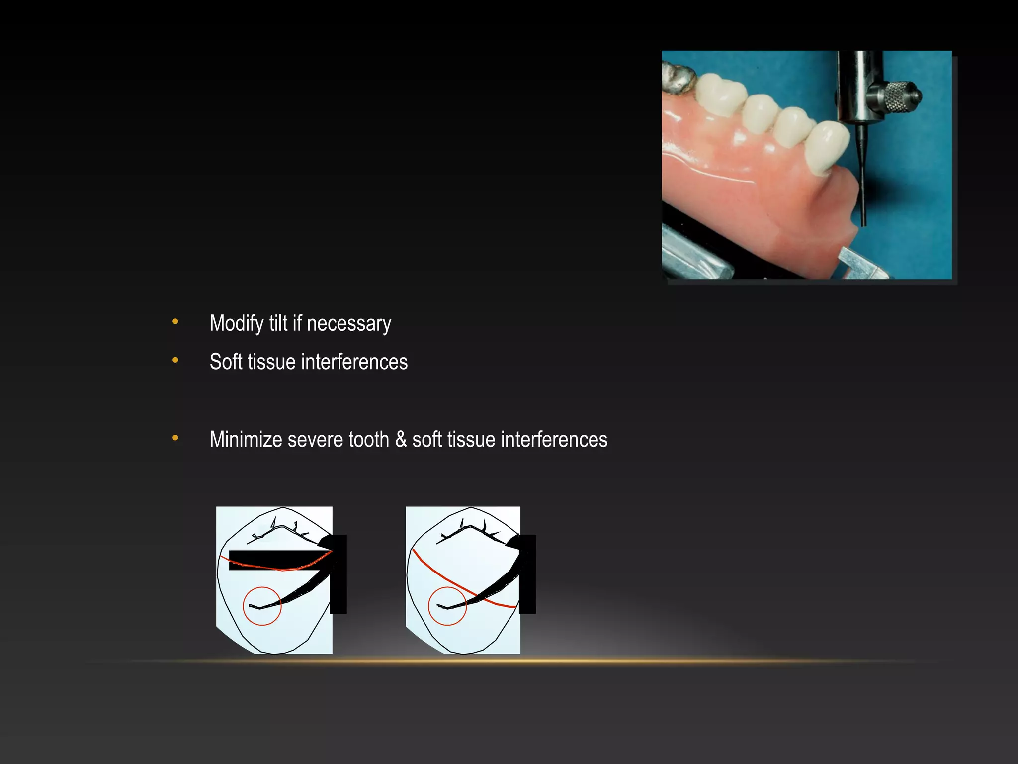 removable partial denture survey lines, path of insertion, guide planes ...