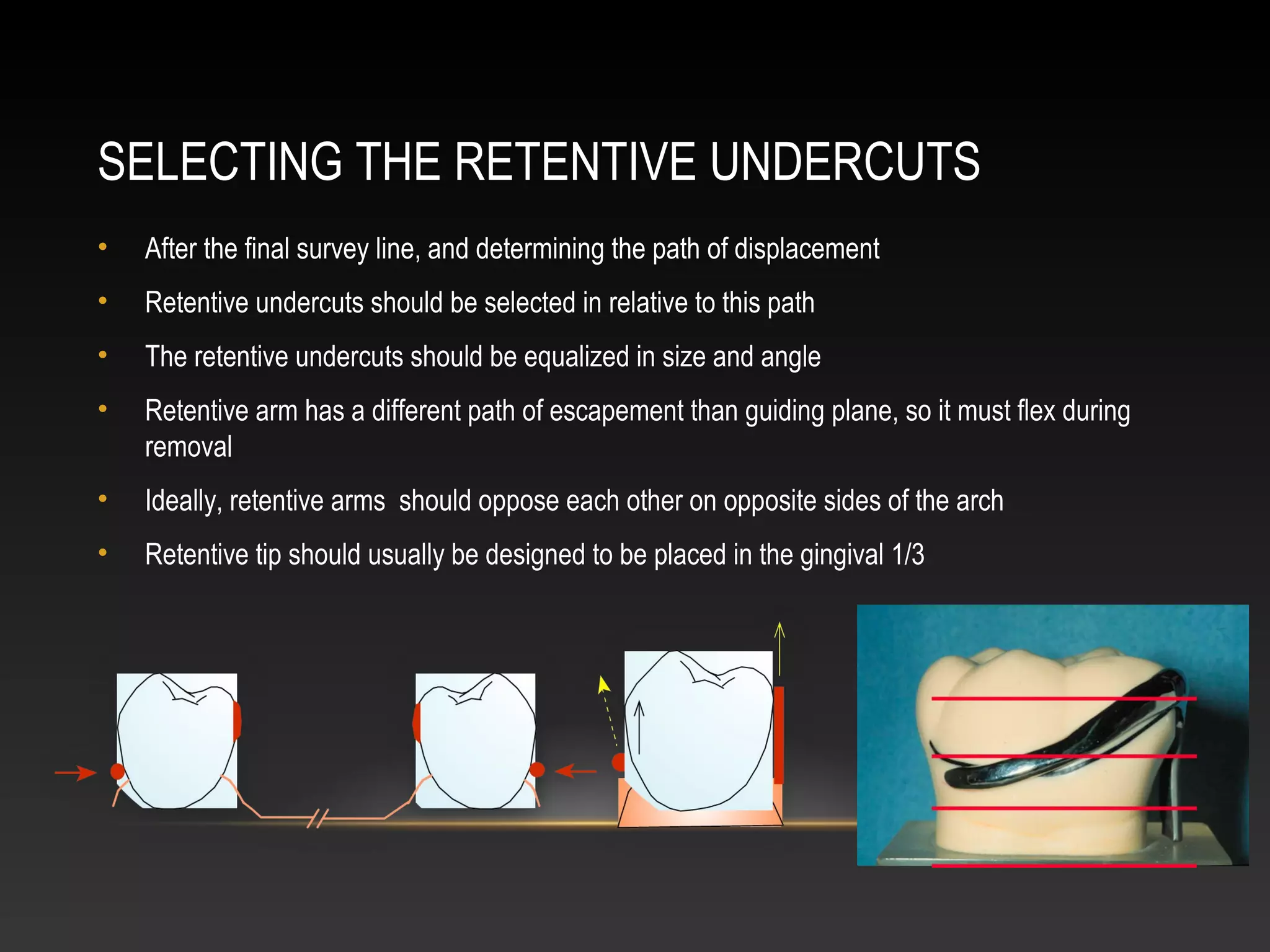 removable partial denture survey lines, path of insertion, guide planes ...