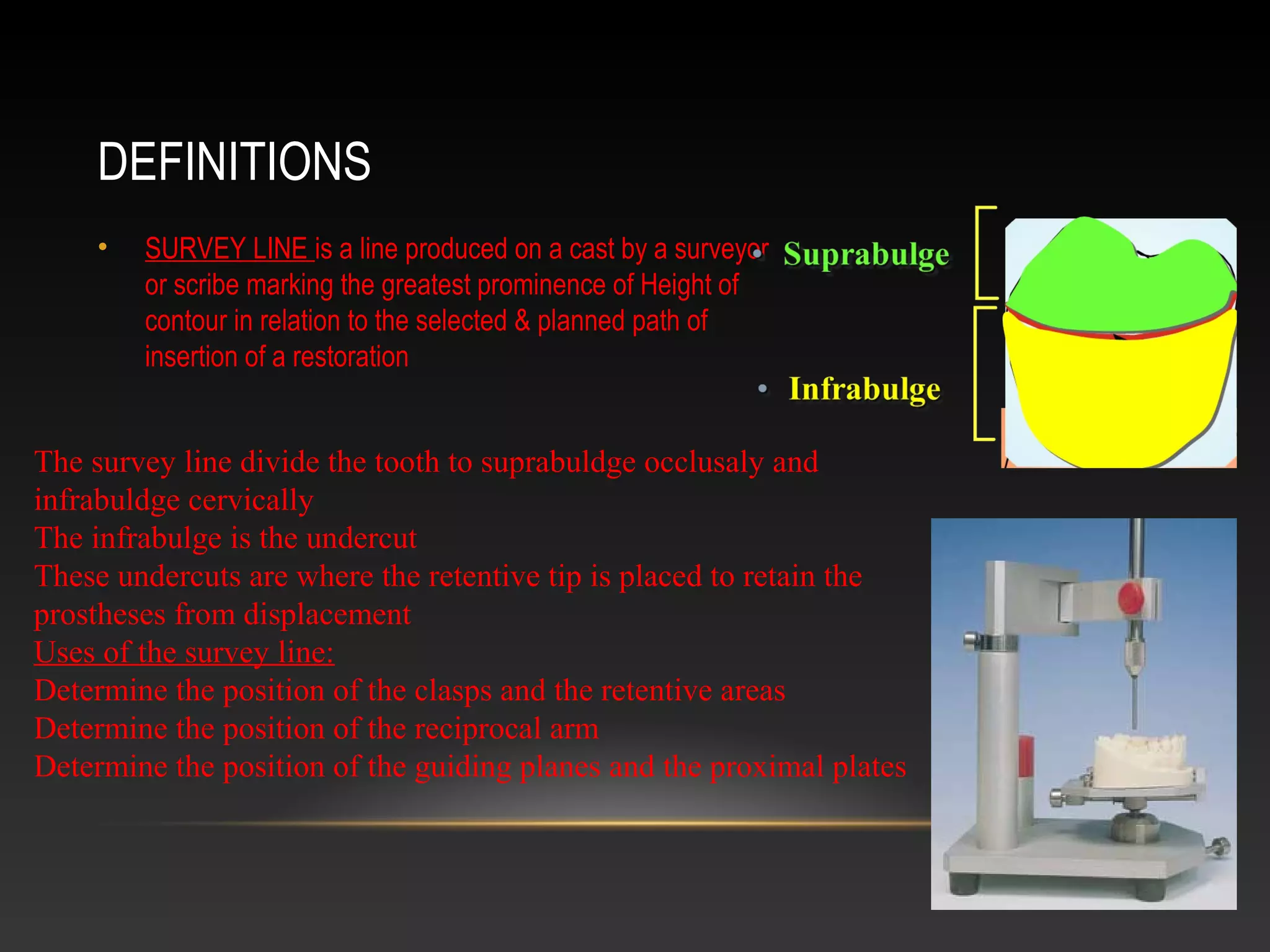 removable partial denture survey lines, path of insertion, guide planes ...