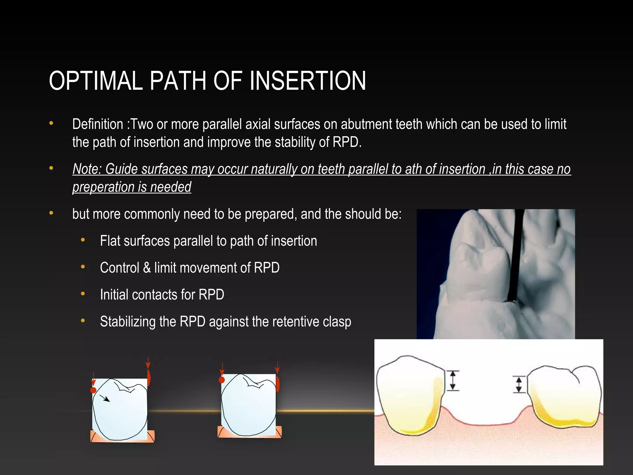 removable partial denture survey lines, path of insertion, guide planes ...