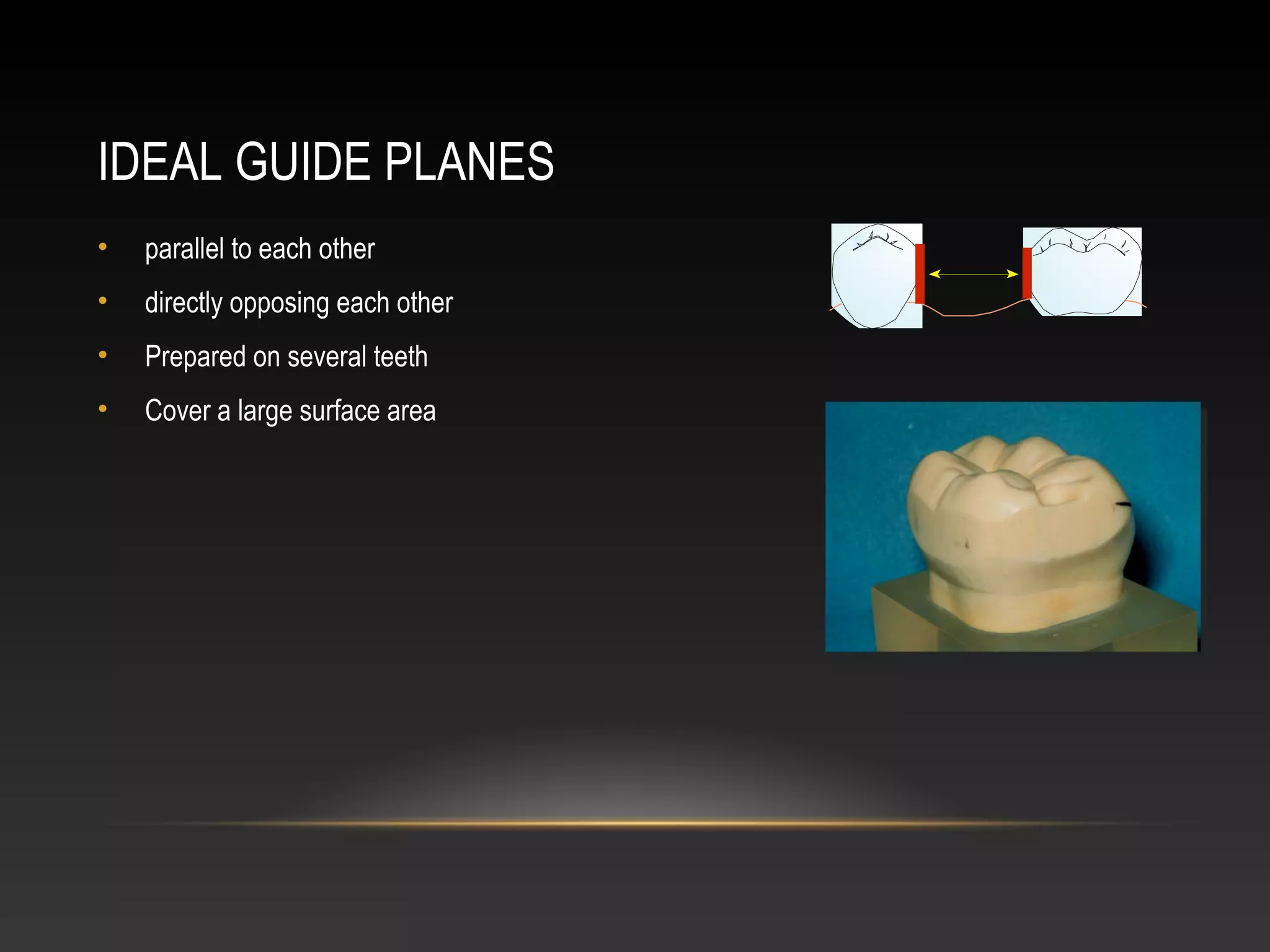 removable partial denture survey lines, path of insertion, guide planes ...