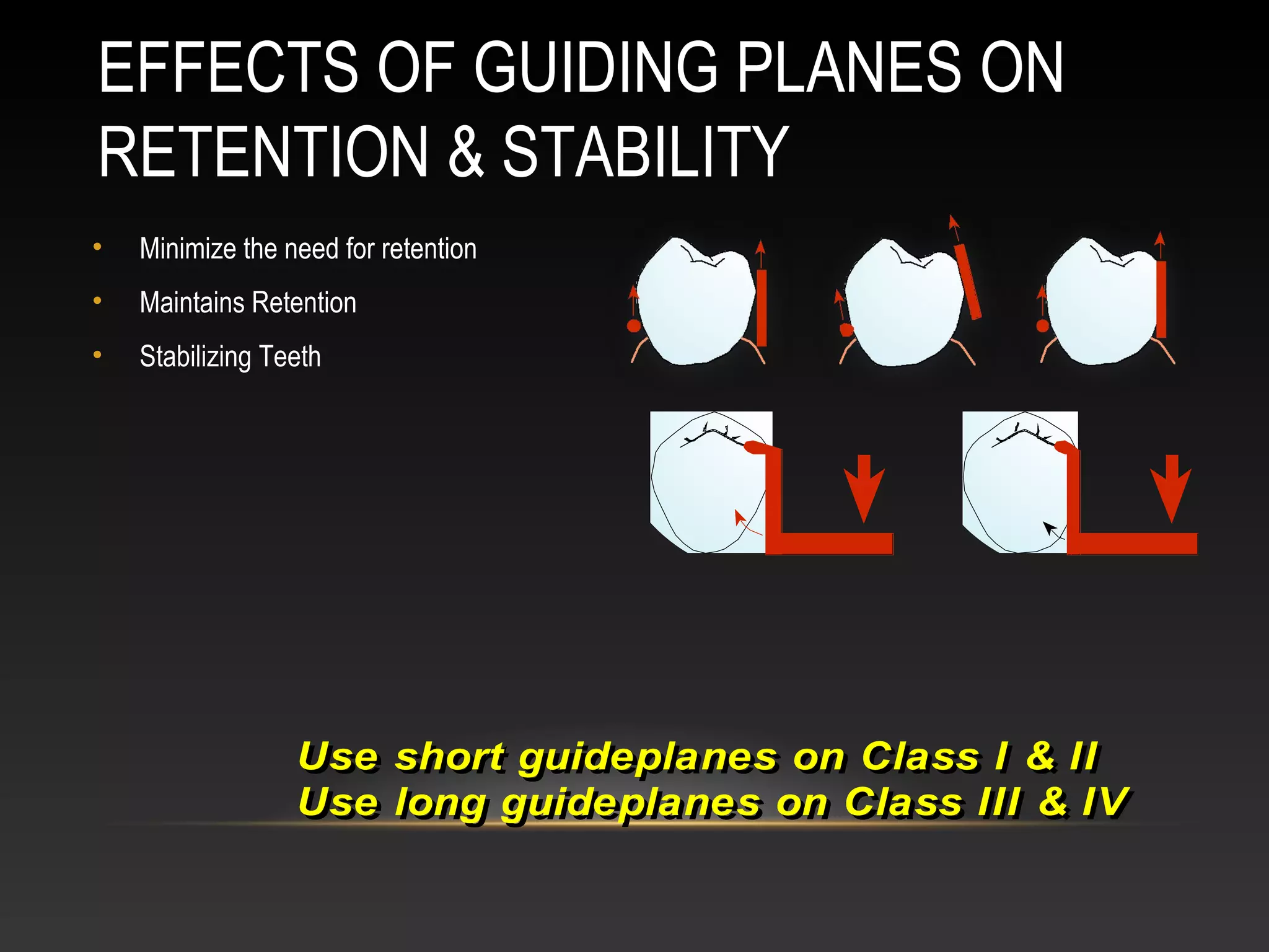 removable partial denture survey lines, path of insertion, guide planes ...