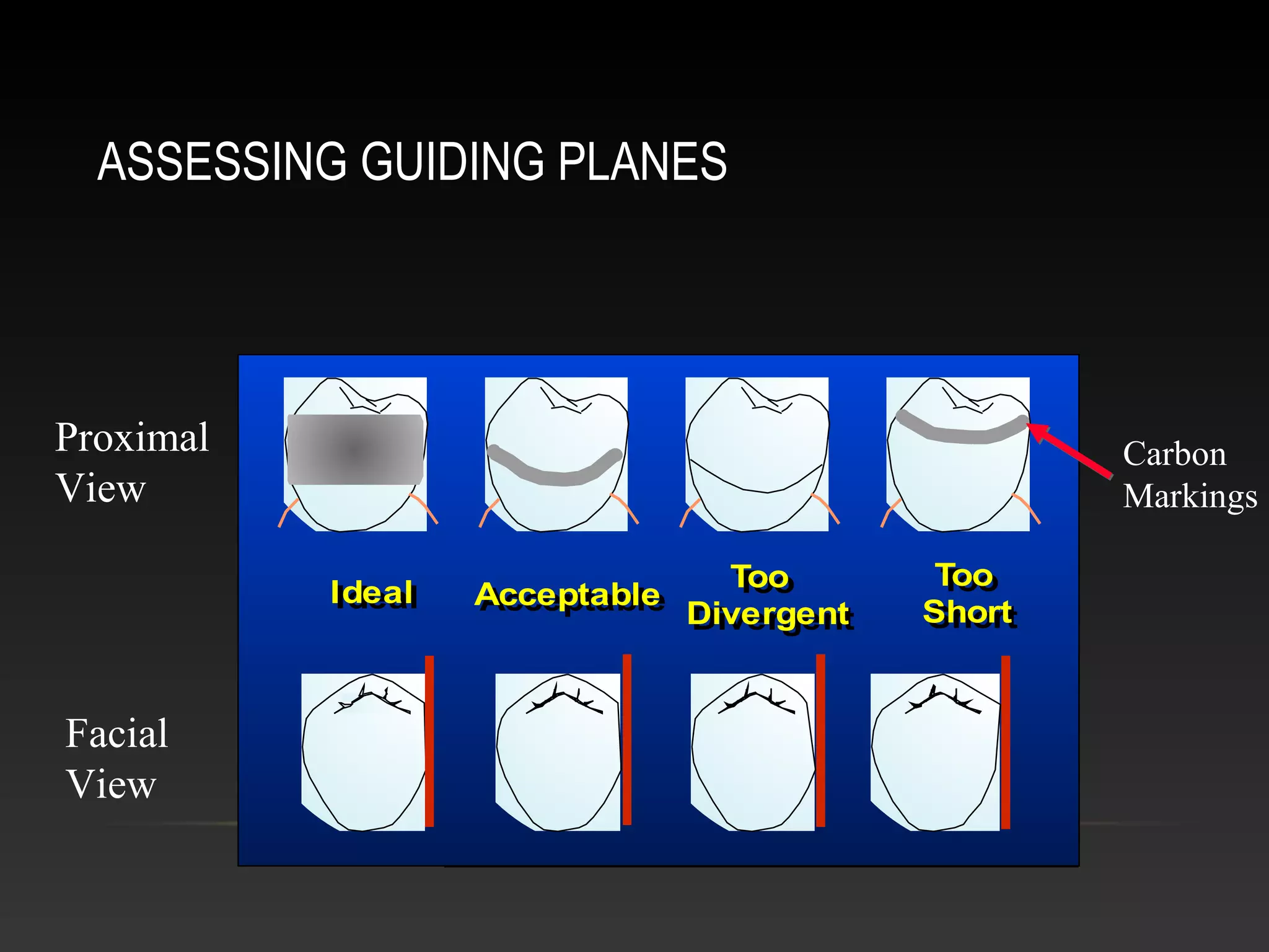 removable partial denture survey lines, path of insertion, guide planes ...