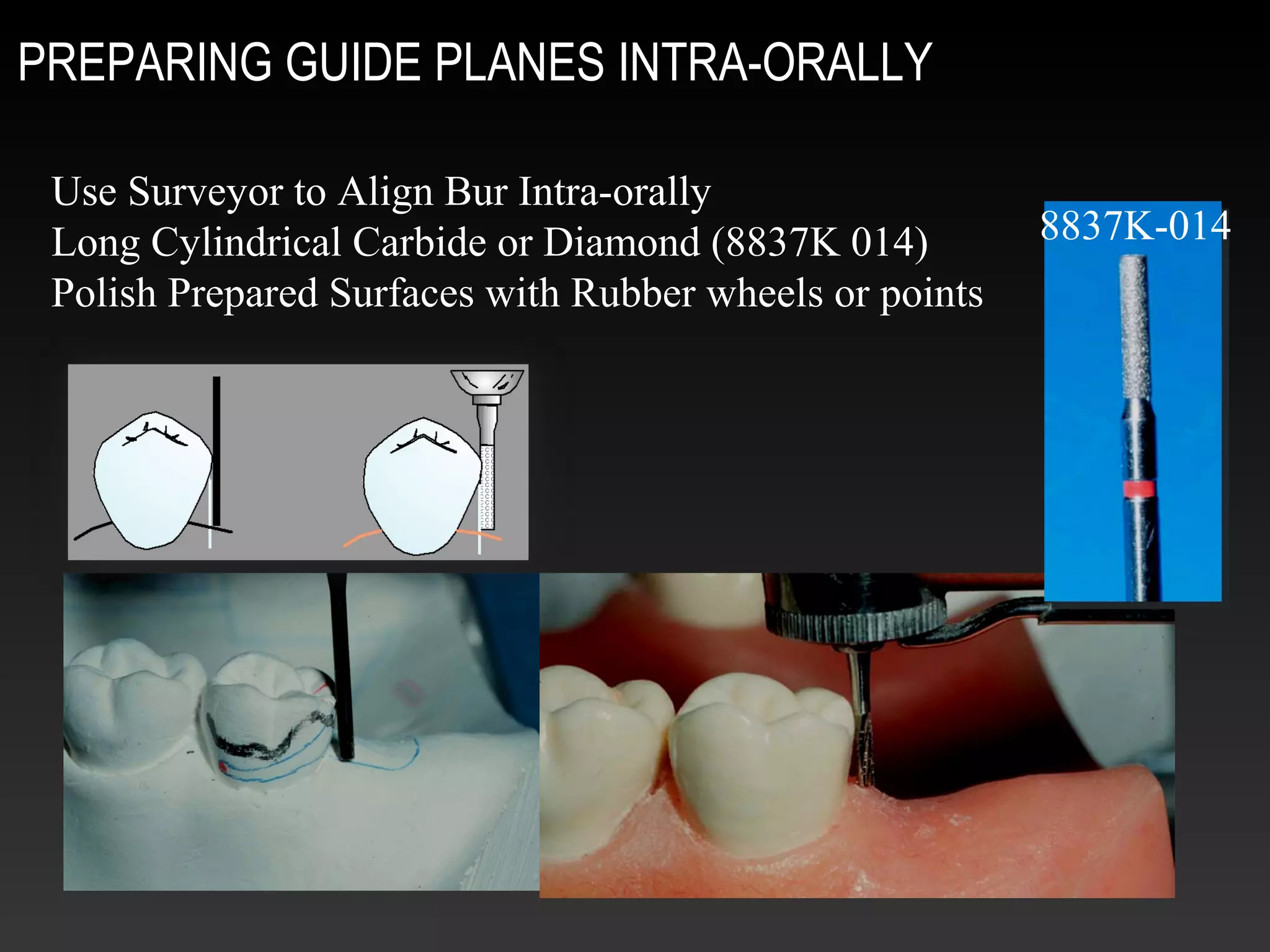 removable partial denture survey lines, path of insertion, guide planes ...